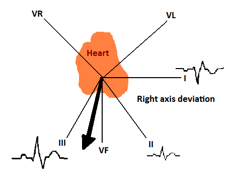 Understanding ECGs - almostadoctor
